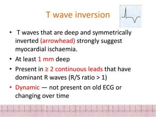 ECG changes in myocardial Ischemia and injury | PPTX