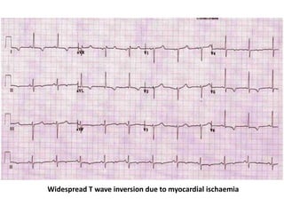 ECG changes in myocardial Ischemia and injury | PPTX