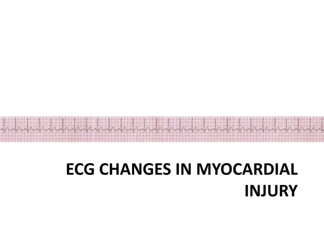 ECG changes in myocardial Ischemia and injury | PPTX | Heart and ...