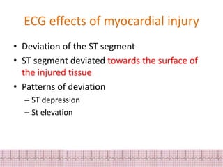ECG changes in myocardial Ischemia and injury | PPTX
