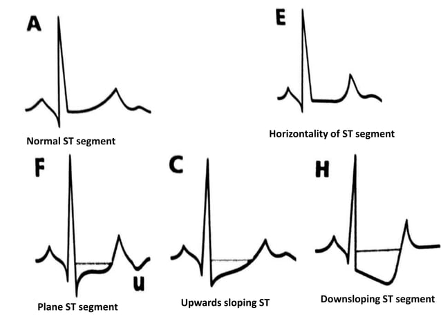 ECG changes in myocardial Ischemia and injury | PPTX | Heart and ...