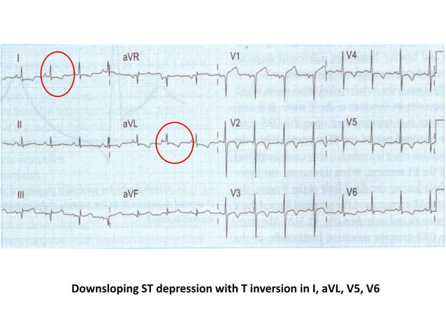 ECG changes in myocardial Ischemia and injury | PPTX | Heart and ...