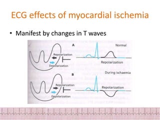 ECG changes in myocardial Ischemia and injury | PPTX
