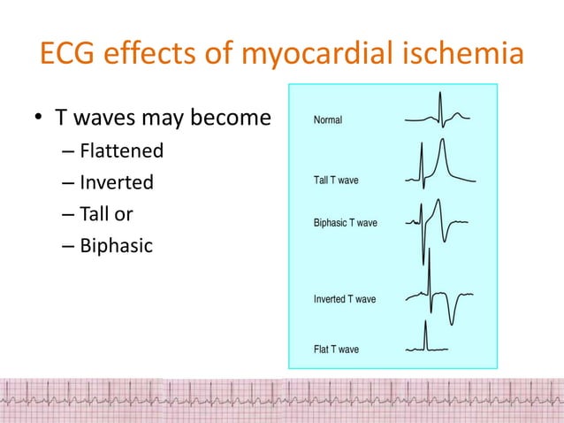 ECG changes in myocardial Ischemia and injury | PPTX | Heart and ...