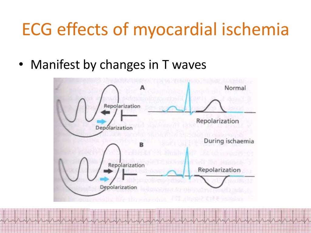 ECG changes in myocardial Ischemia and injury
