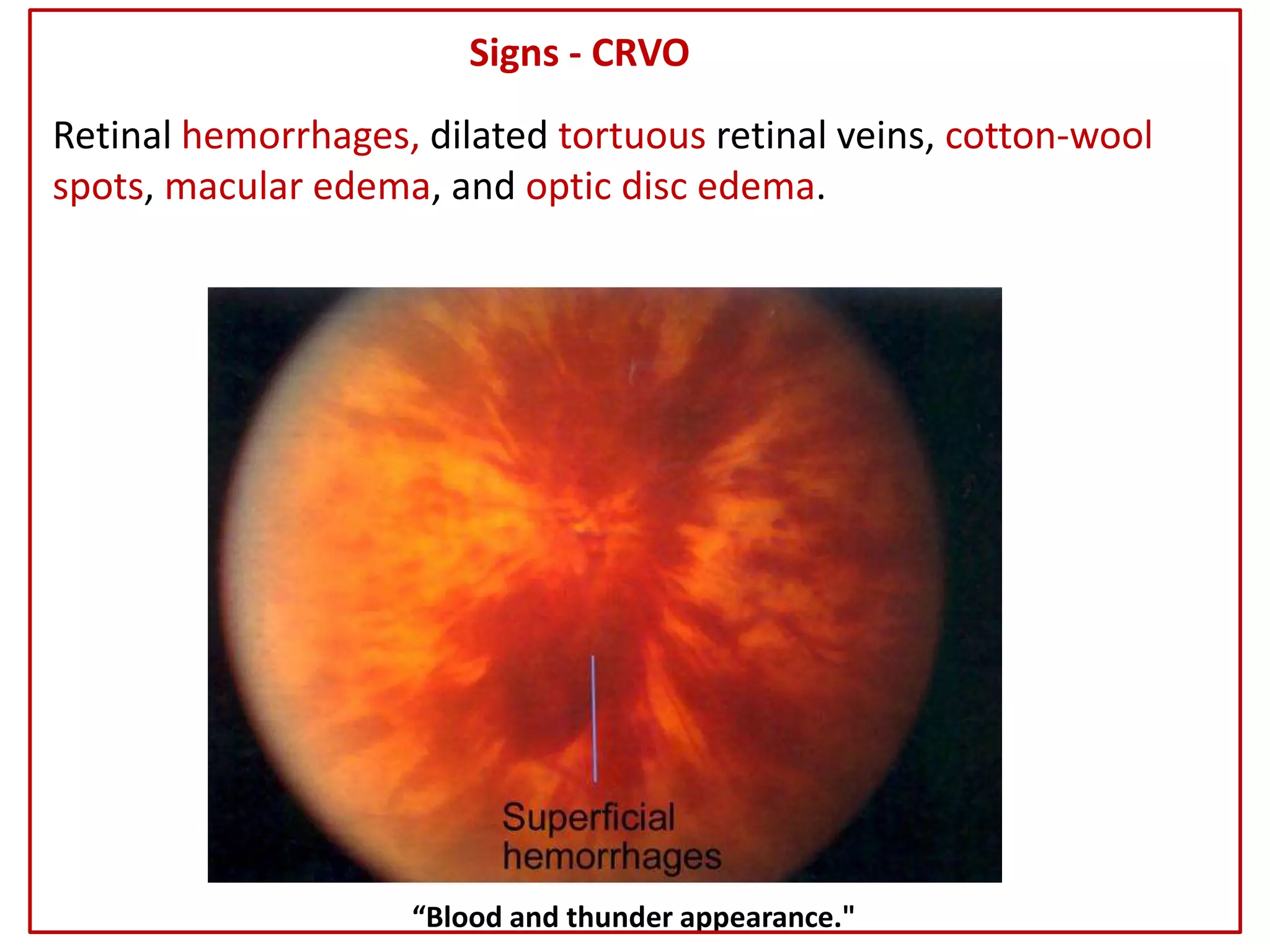 Ischemic of optic neuropathy, Optic Neuropathy (Ischemic), Eye Stroke ...