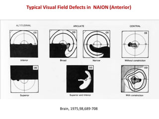 Ischemic of optic neuropathy, Optic Neuropathy (Ischemic), Eye Stroke ...