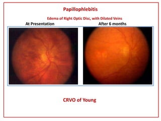 Ischemic of optic neuropathy, Optic Neuropathy (Ischemic), Eye Stroke ...