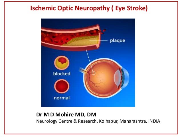 Ischemic of optic neuropathy, Optic Neuropathy (Ischemic), Eye Stroke…