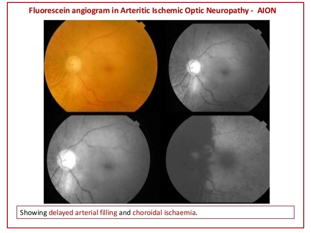 Ischemic of optic neuropathy, Optic Neuropathy (Ischemic), Eye Stroke…