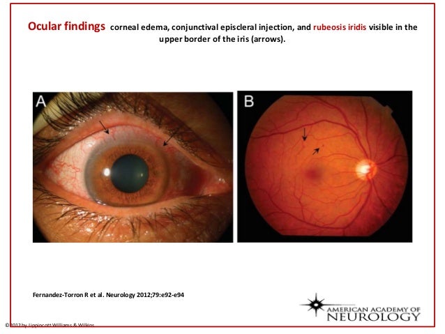 Ischemic of optic neuropathy, Optic Neuropathy (Ischemic), Eye Stroke…