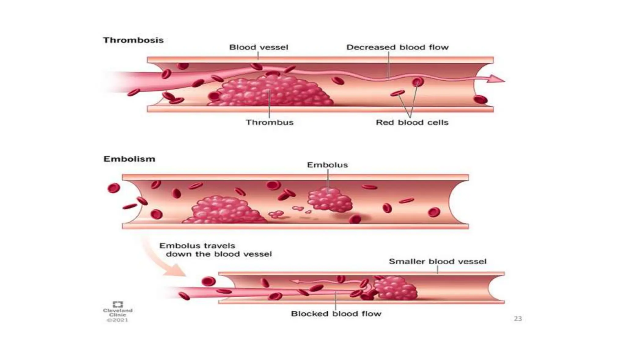 Ischaemic stroke pathogenesis and treatment | PPTX | Brain and Nervous ...