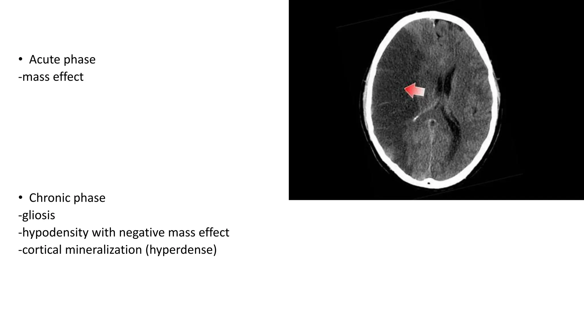 Ischaemic stroke pathogenesis and treatment | PPTX | Brain and Nervous ...