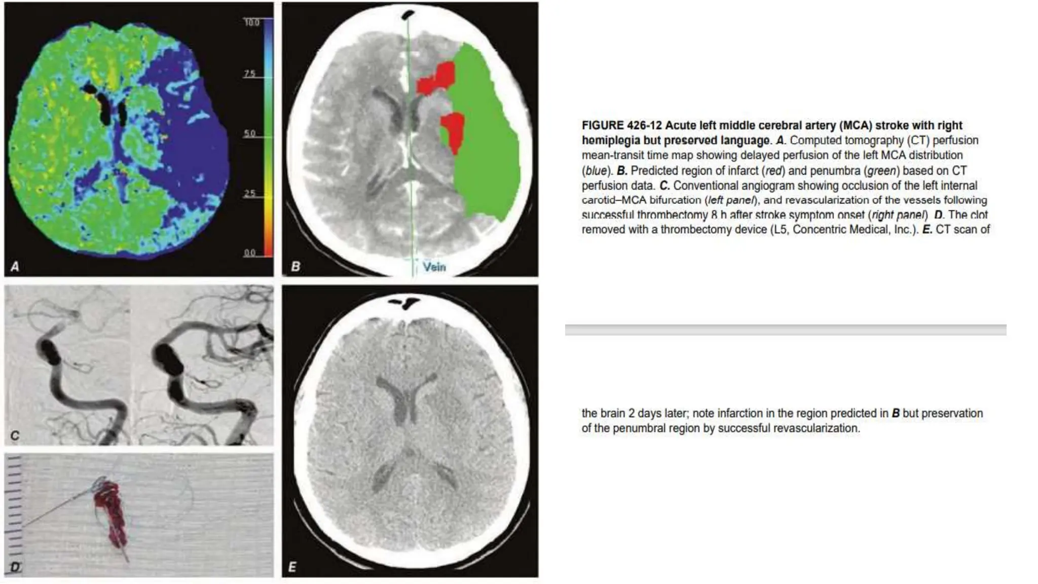 Ischaemic stroke pathogenesis and treatment | PPTX | Brain and Nervous ...