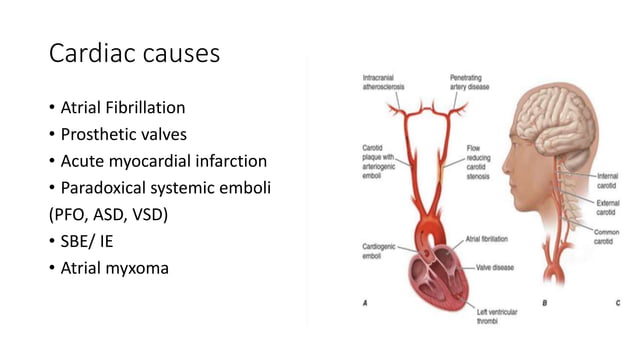 Ischaemic stroke pathogenesis and treatment | PPTX | Brain and Nervous ...