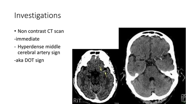 Ischaemic stroke pathogenesis and treatment | PPTX | Brain and Nervous System Disorders ...