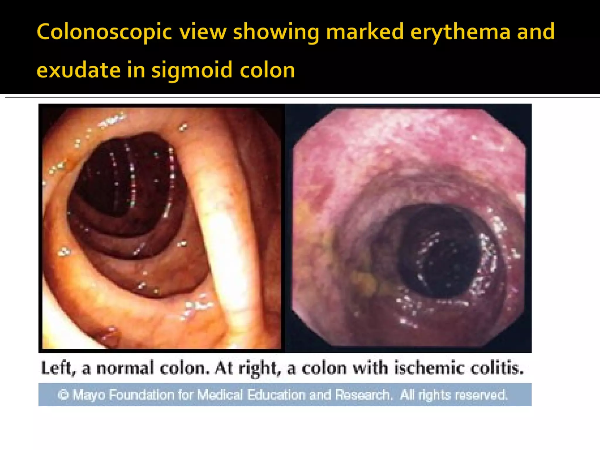 Ischemic colitis | PPT