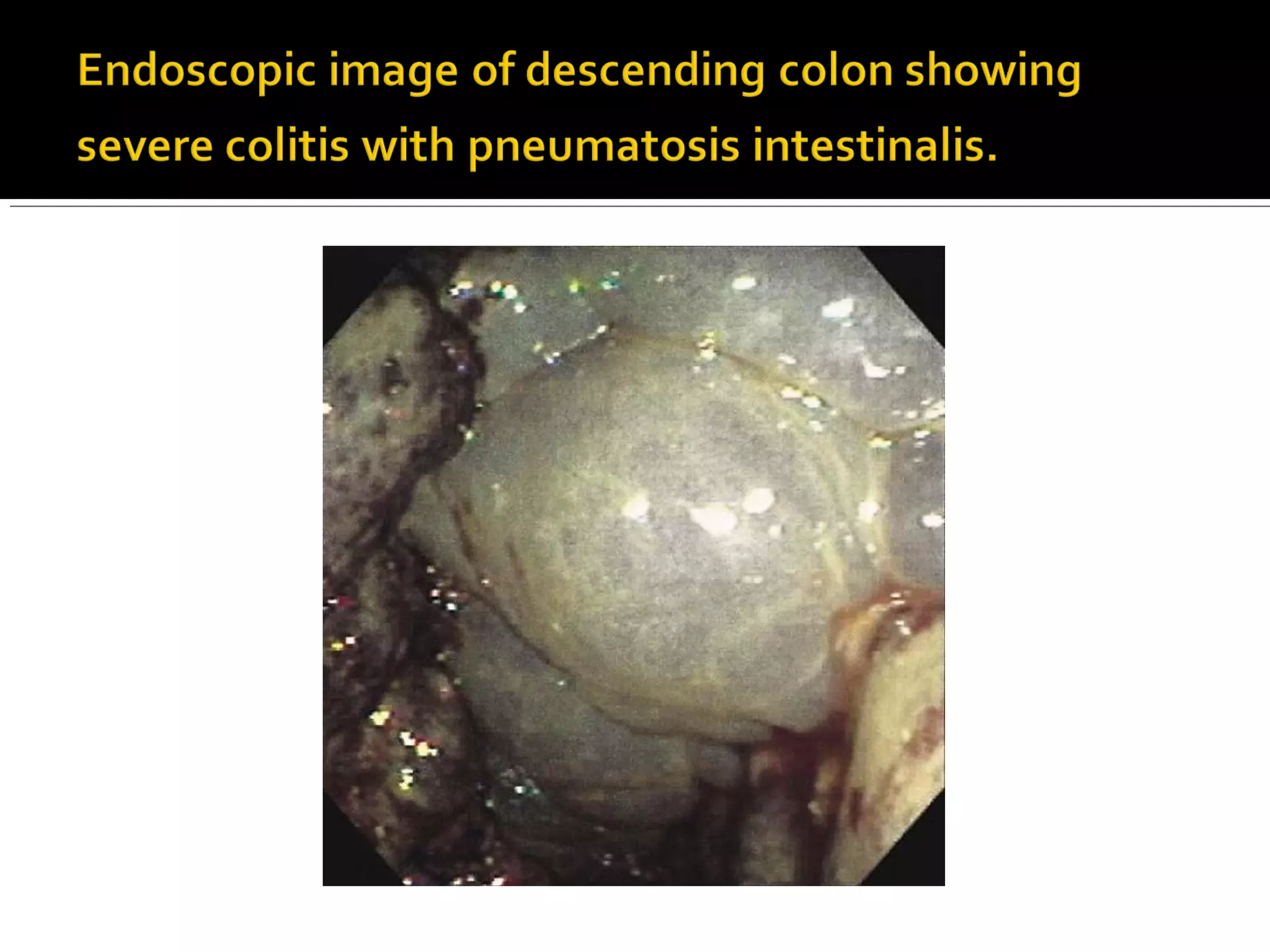 Ischemic colitis | PPT