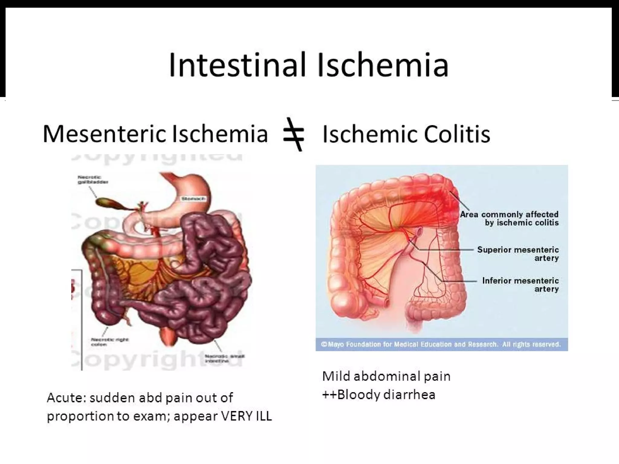 Ischemic colitis | PPT