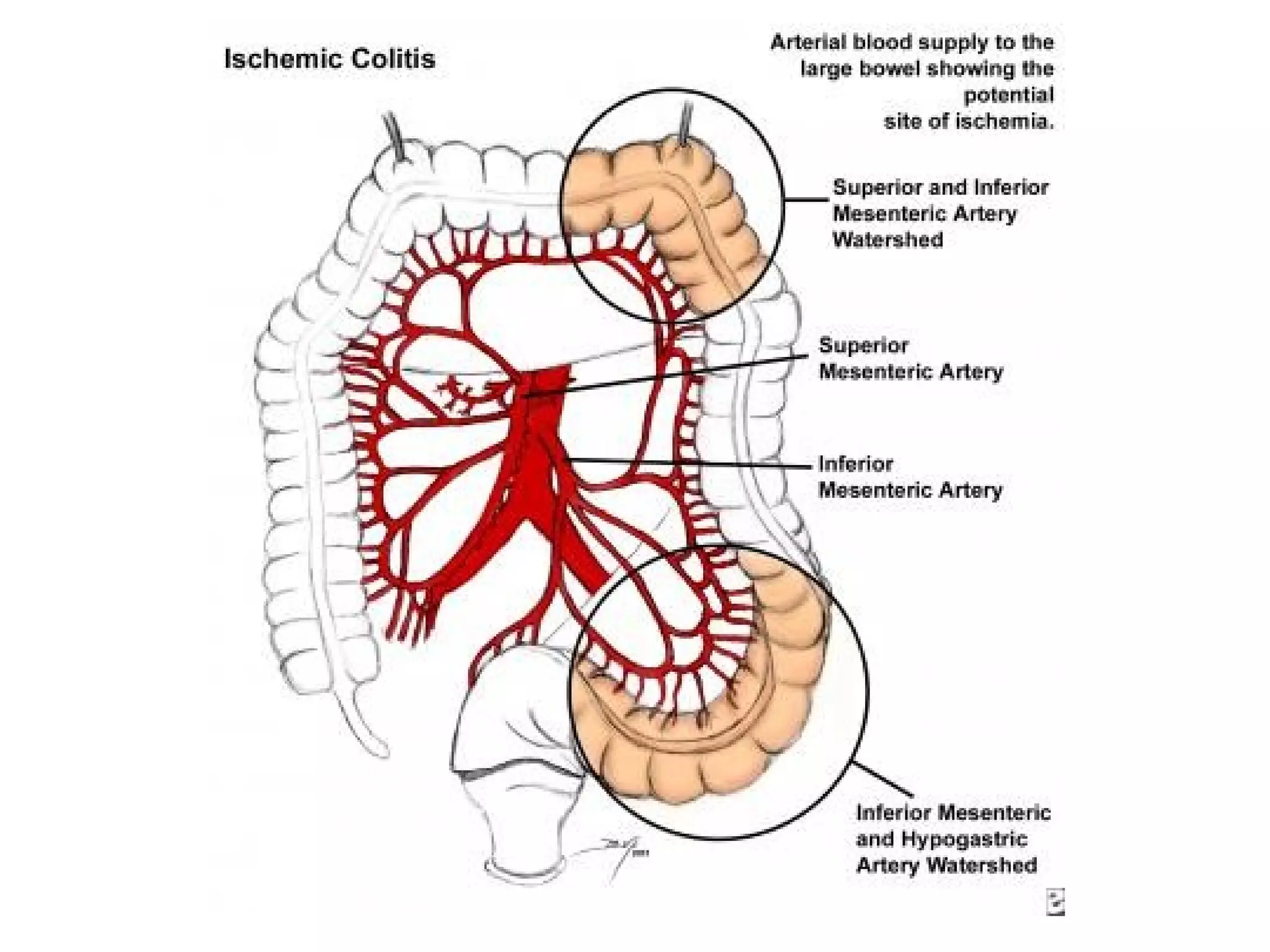 Ischemic colitis | PPT