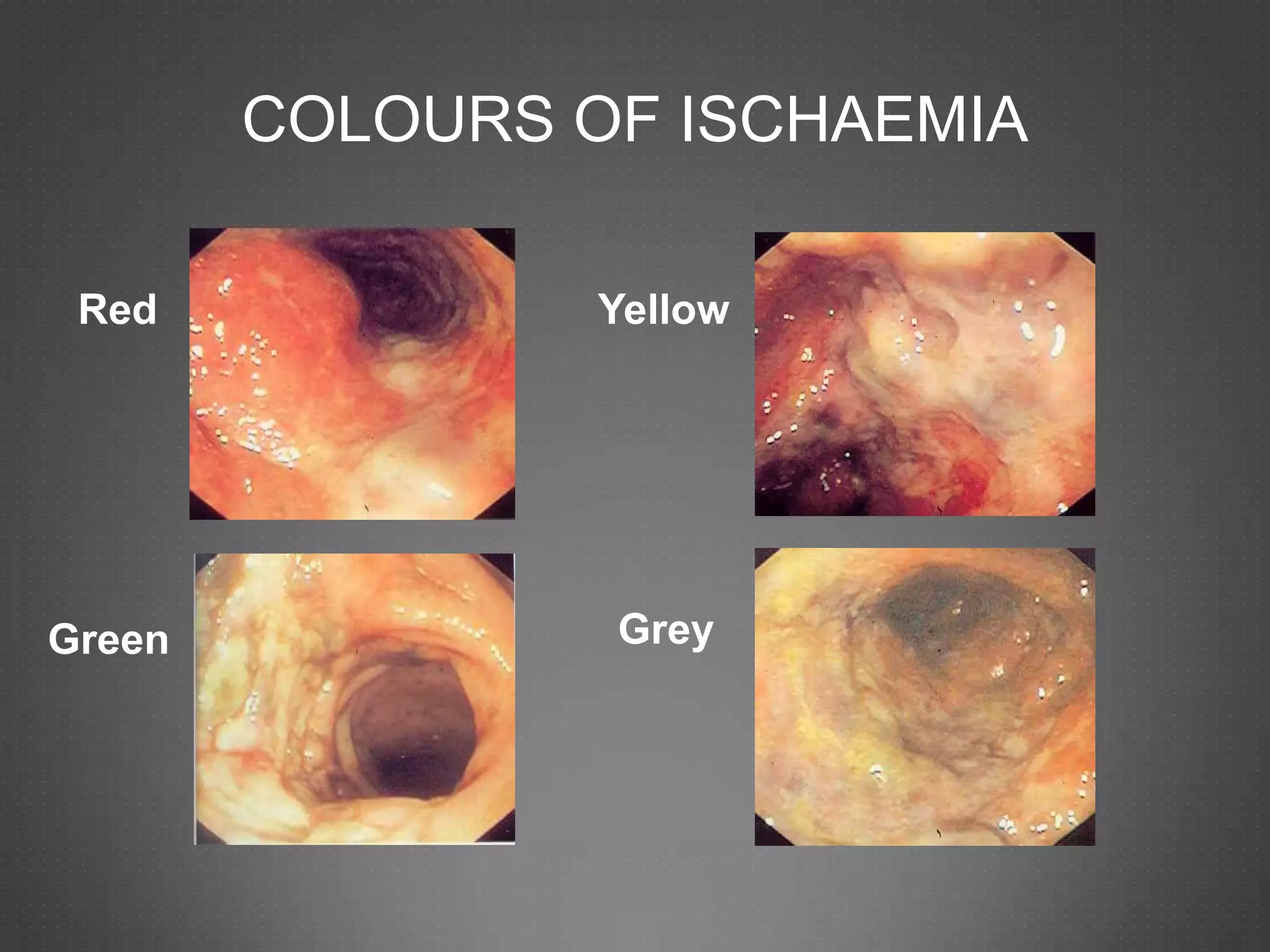 Ischemic colitis | PPT