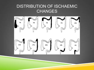 Ischemic colitis | PPT