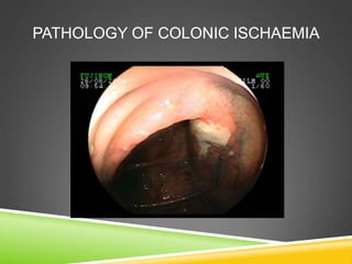 Ischemic colitis | PPT