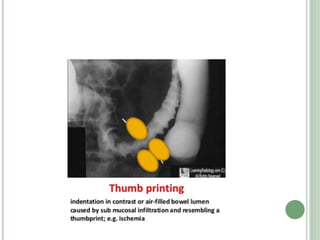 Thumbprint Sign Ischemic Colitis
