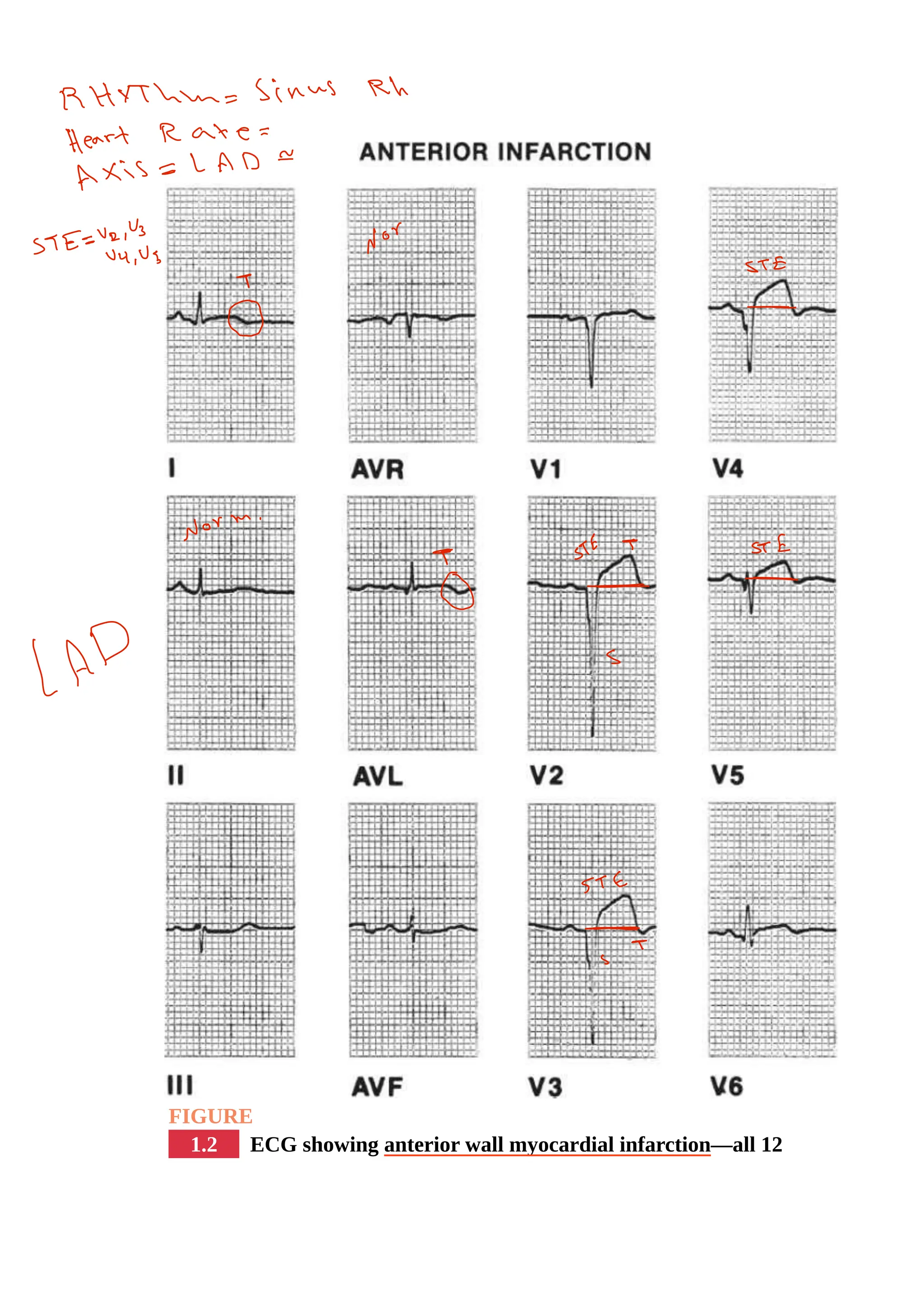 Ischemic Heart Disease - Myocardial Infarction.pdf