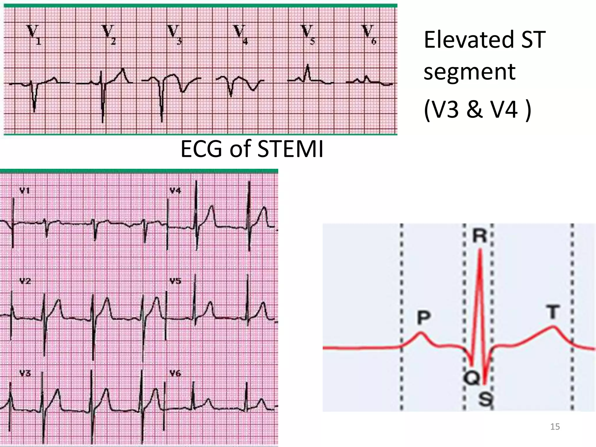 Ischemic Heart Disease for MSc nurses.pptx