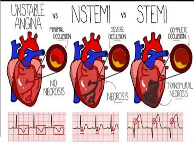 Ischemic heart disease (IHD) pathophysiology , types , its causes and ...
