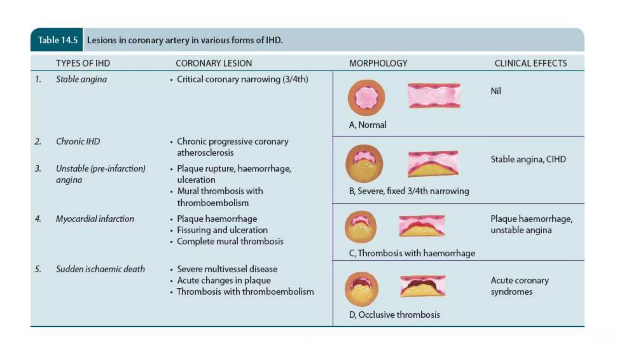 ISCHEMIC HEART DISEASE (IHD) | PPTX