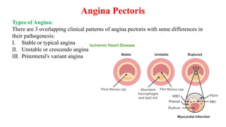 Ischemic Heart Diseases-Angina pectoris.pptx