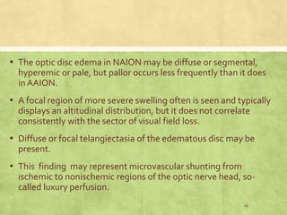 Ischemic optic neuropathies | PPTX