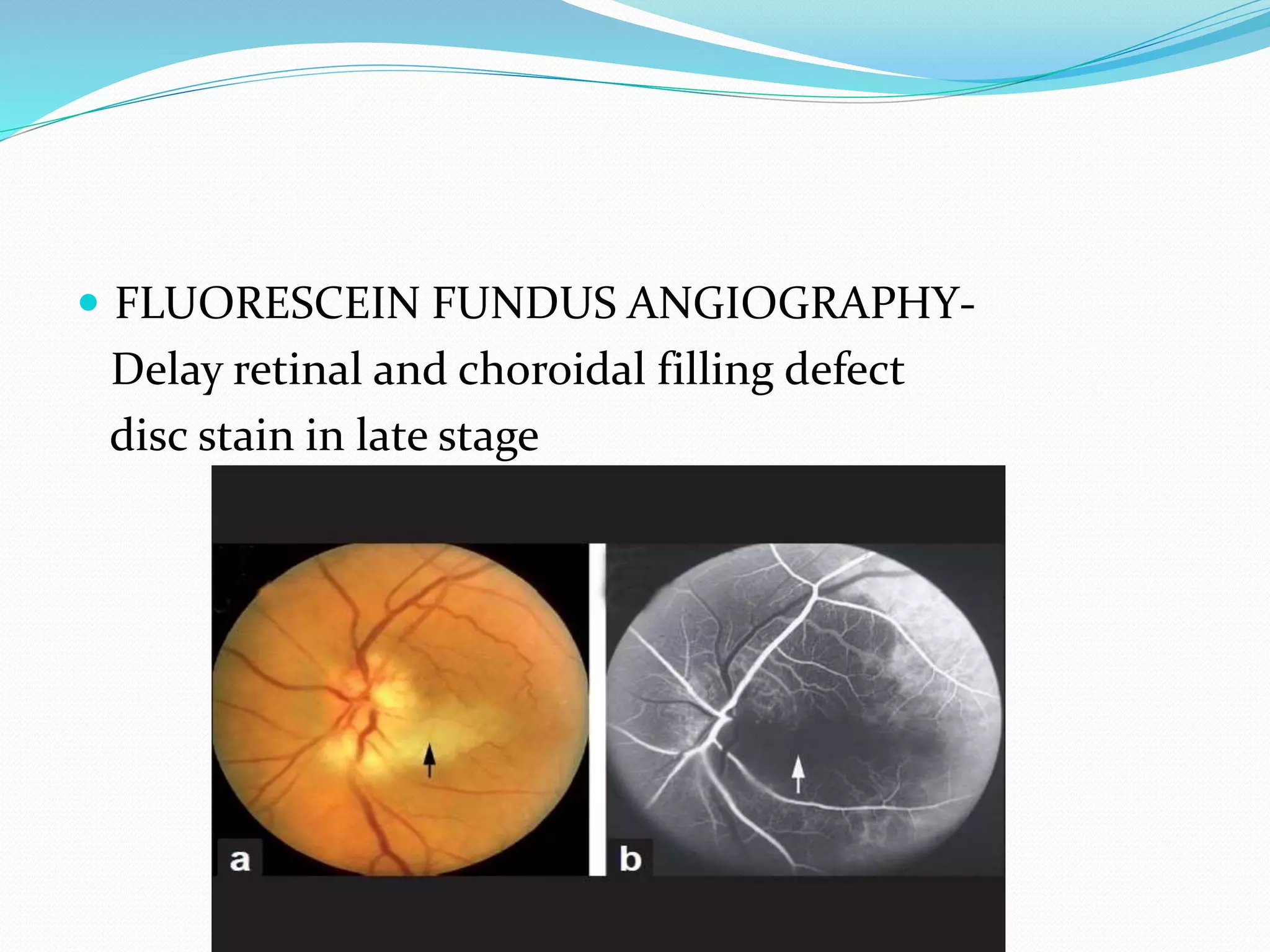 Ischemic optic neuropathy | PPTX