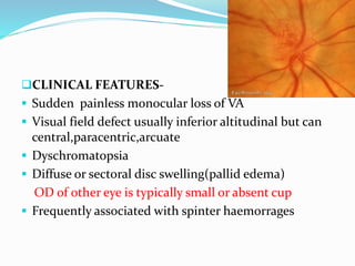 Ischemic optic neuropathy | PPTX
