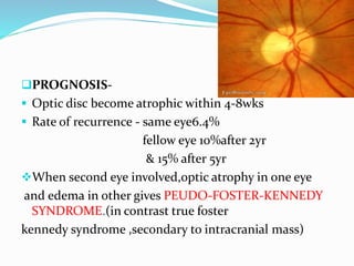 Ischemic optic neuropathy | PPTX