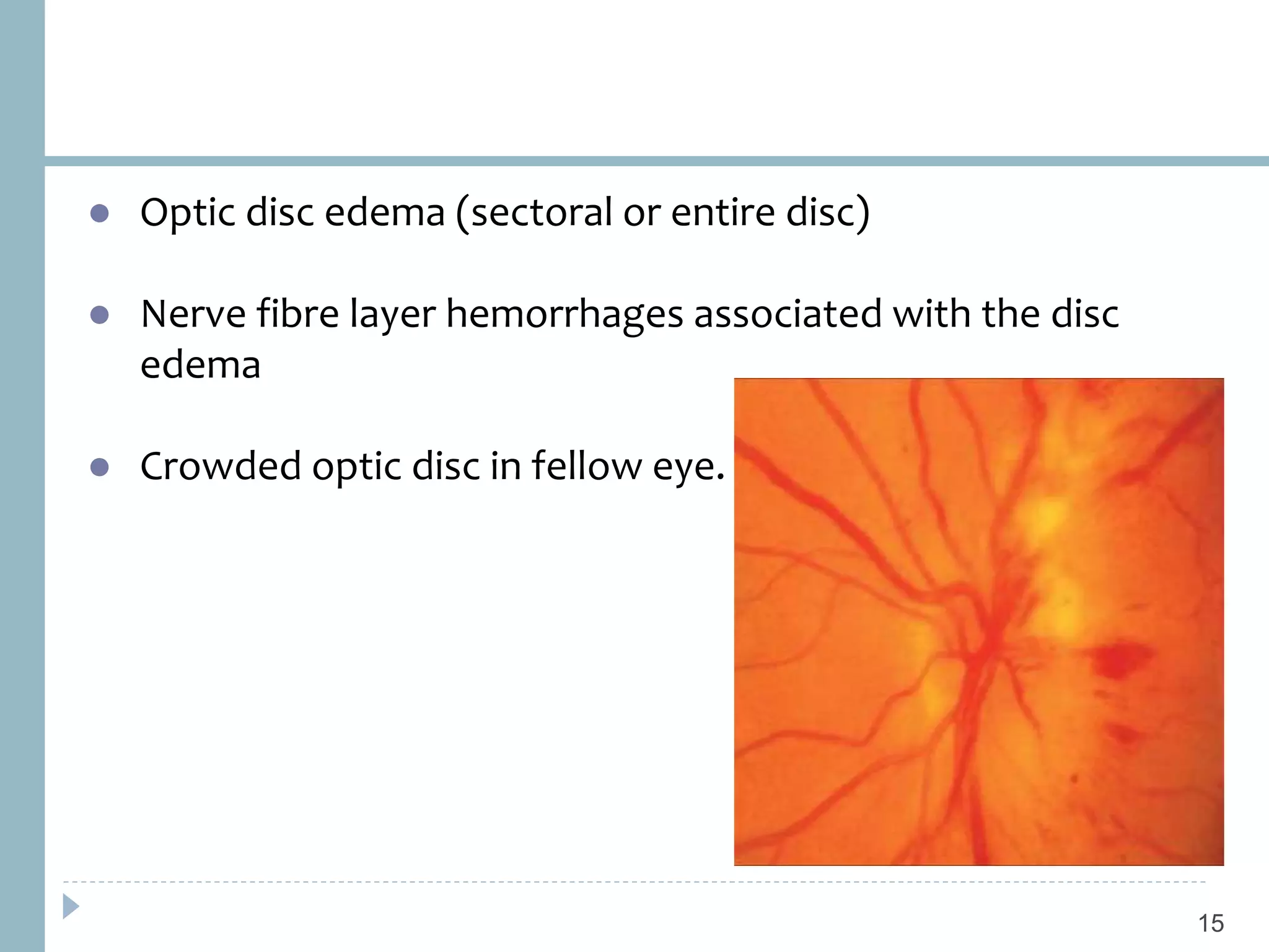 Ischemic Optic Neuropathy 1.pptx