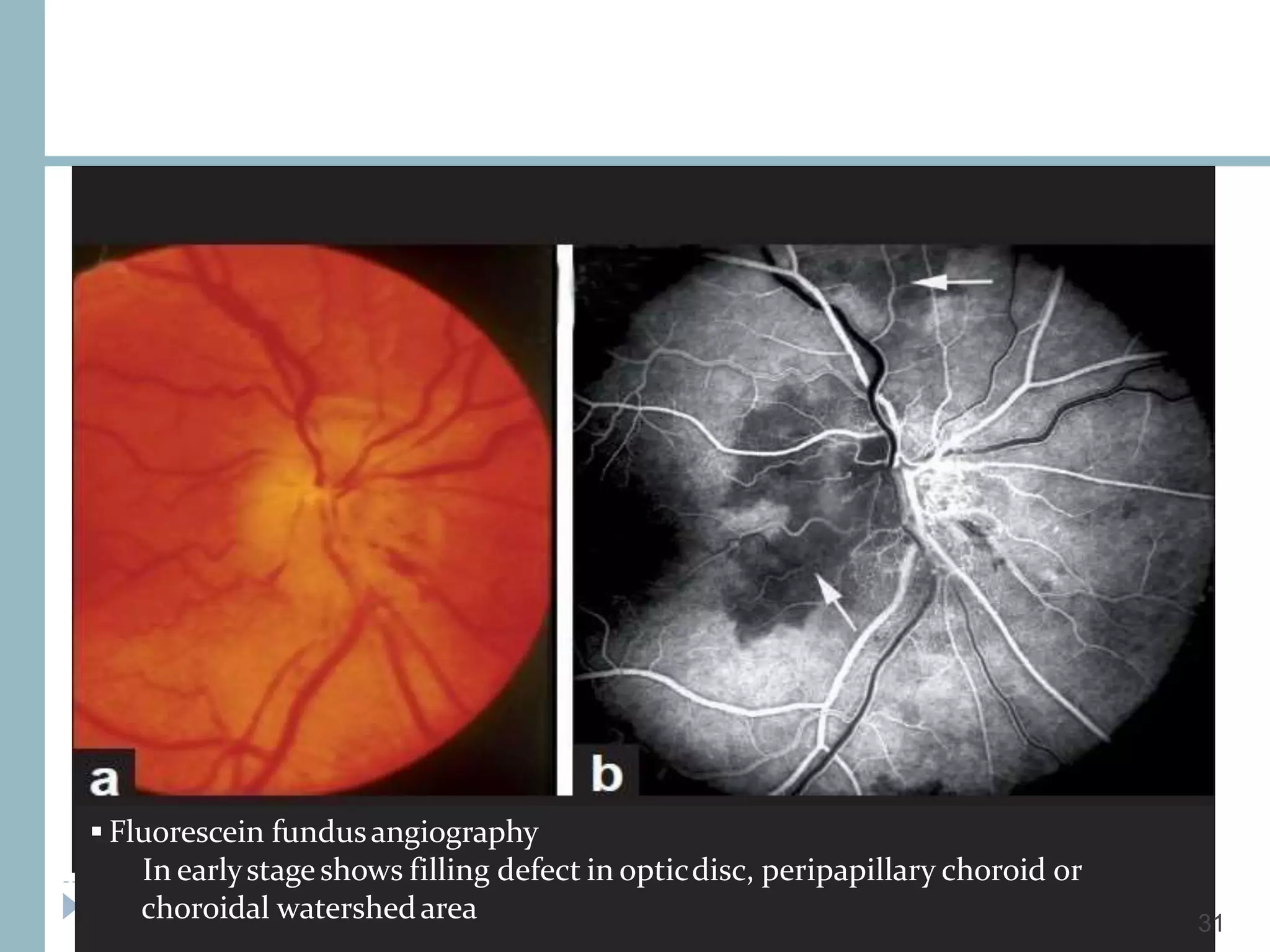 Ischemic Optic Neuropathy 1.pptx