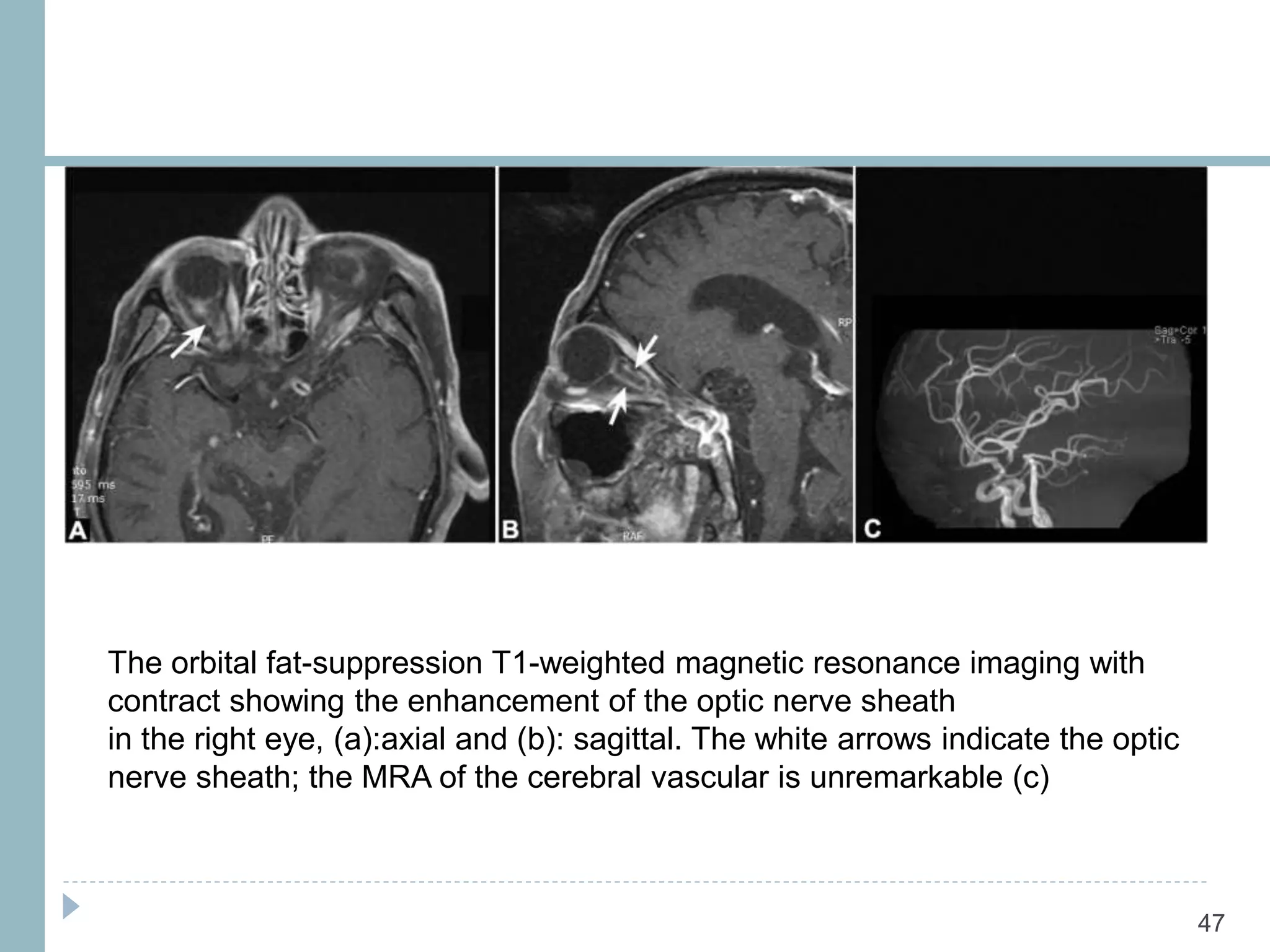 Ischemic Optic Neuropathy 1.pptx
