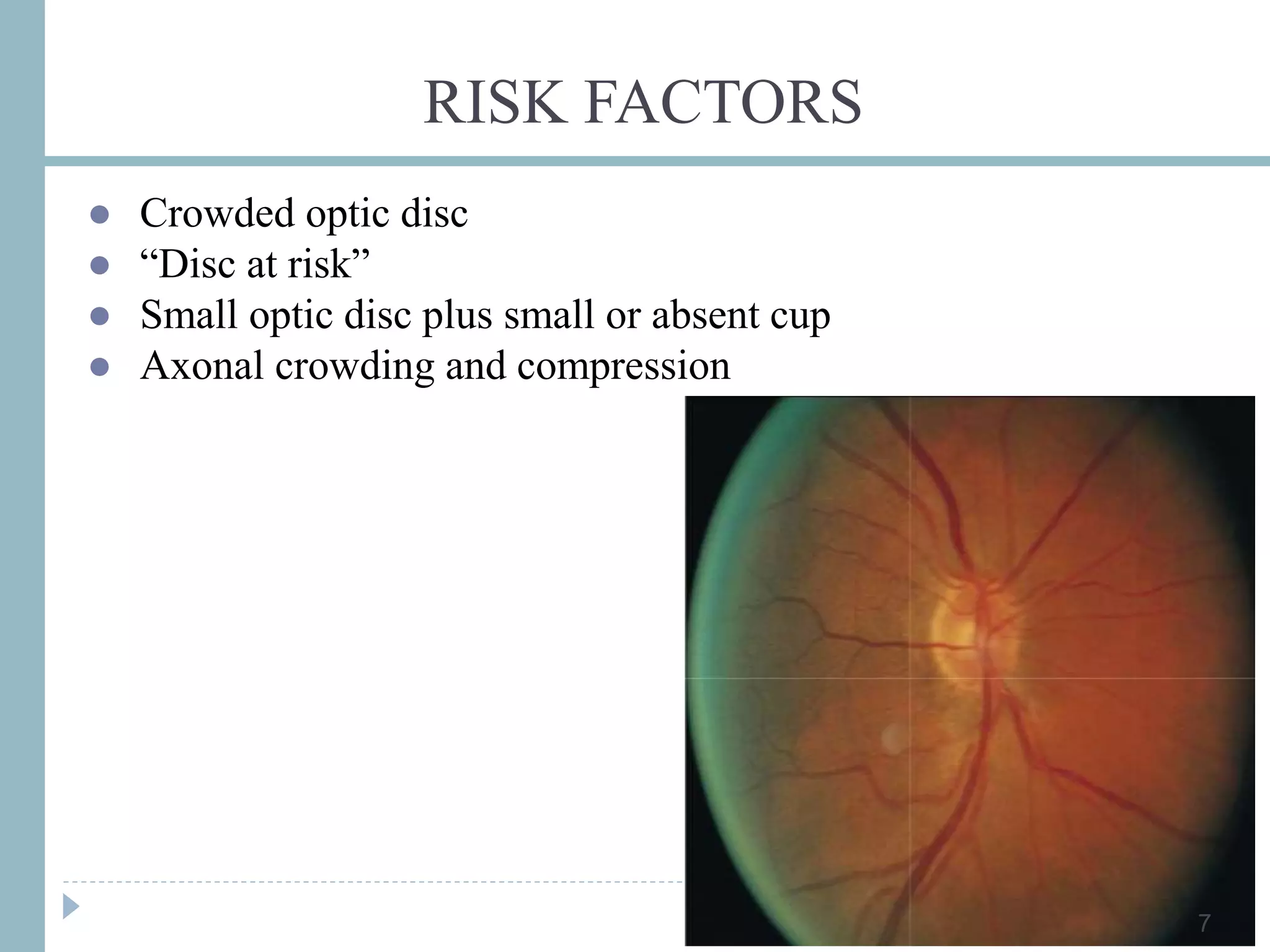 Ischemic Optic Neuropathy 1.pptx