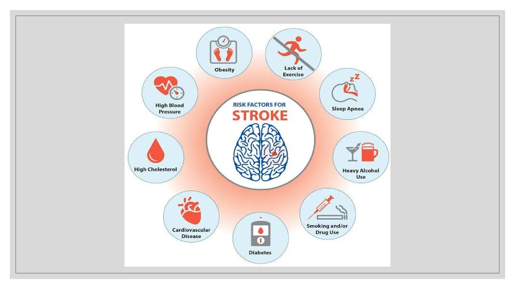 Ischemic stroke presentation for students | PPT