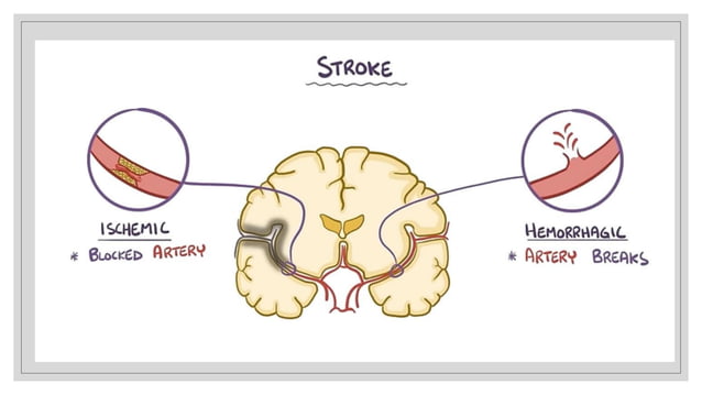 Ischemic stroke presentation for students | PPT