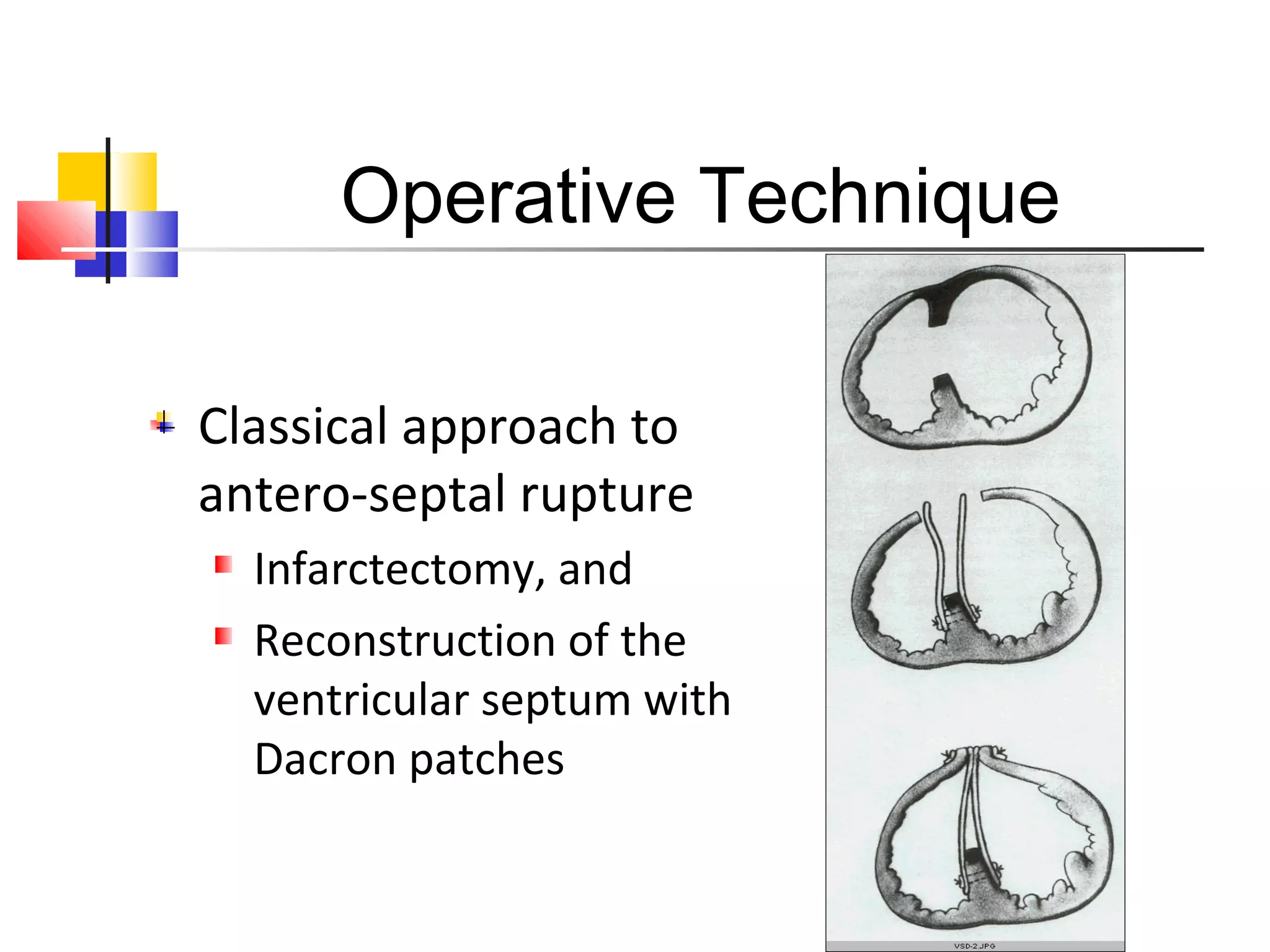 Ischemic ventricular septal_defects_dr.asma