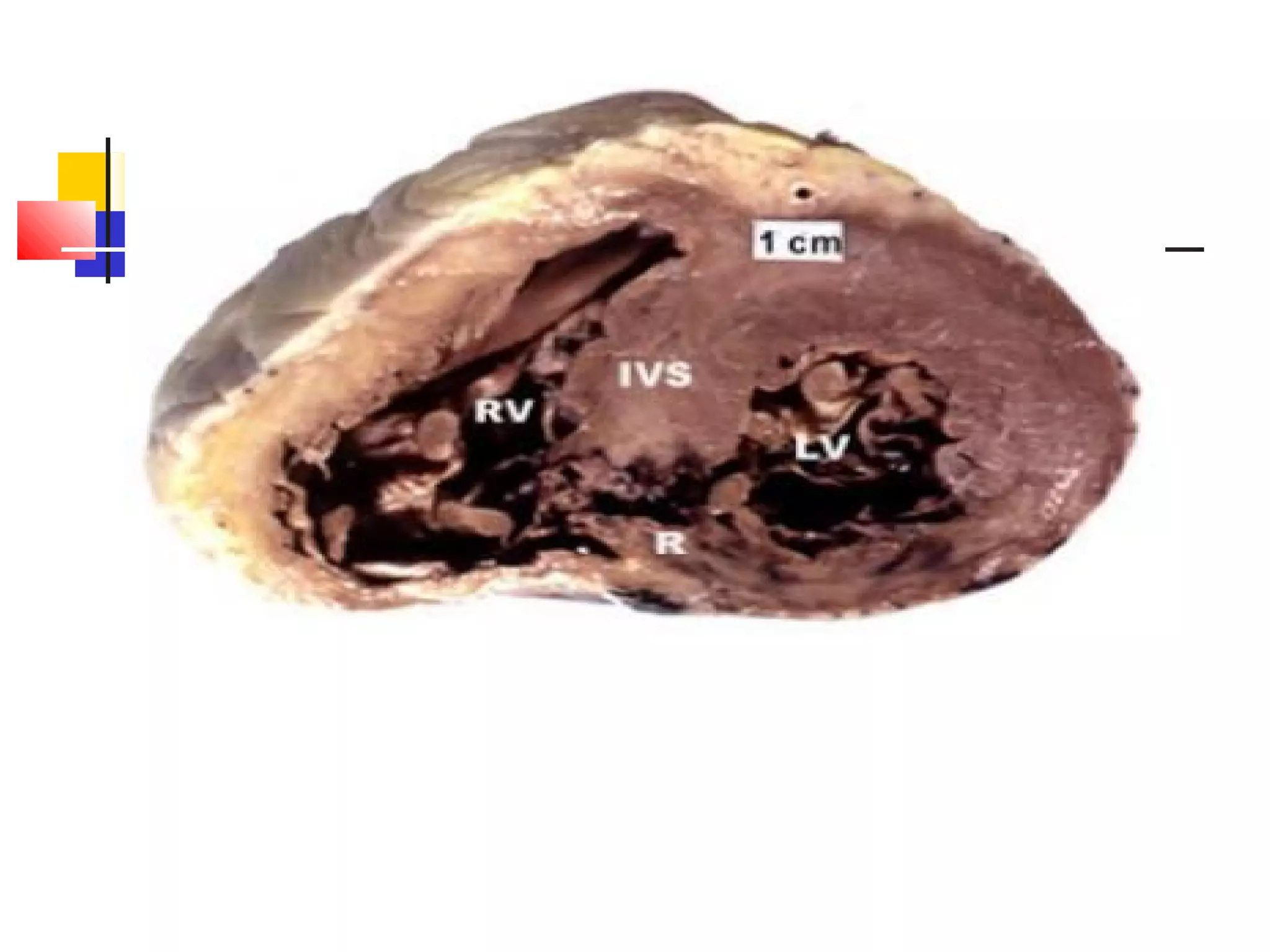 Ischemic ventricular septal_defects_dr.asma