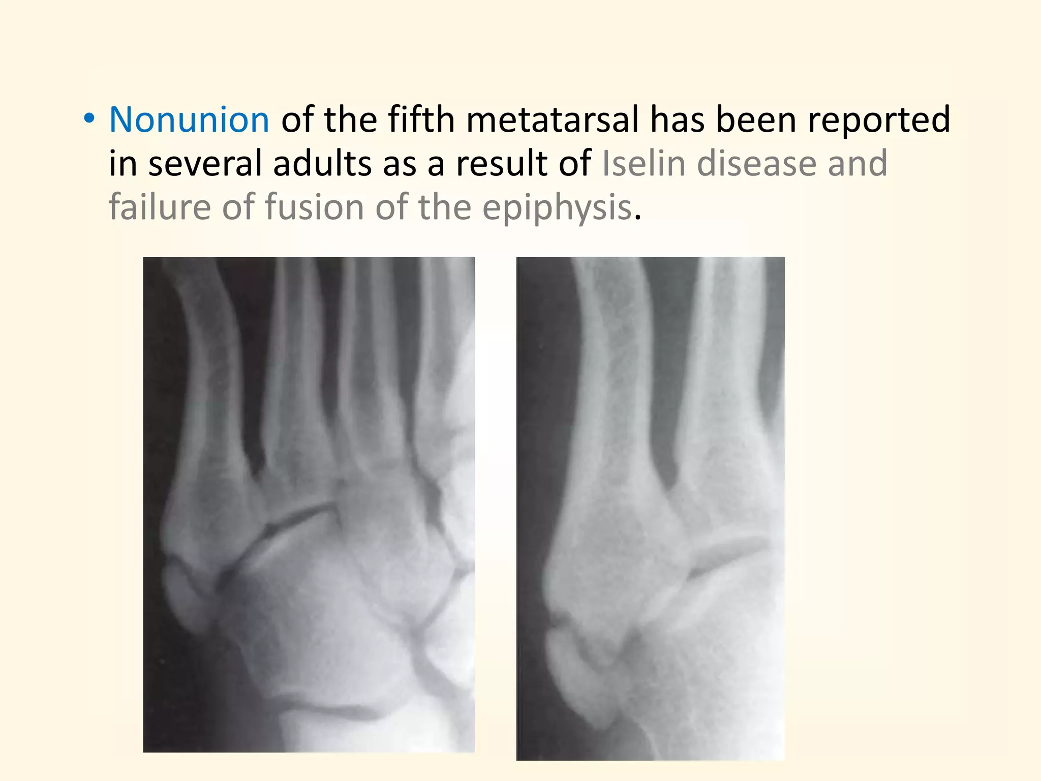 Iselin's disease | PPTX