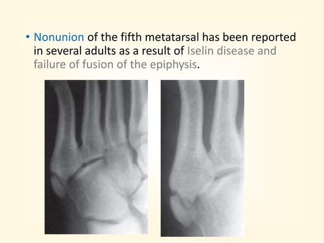 Iselin's disease | PPTX