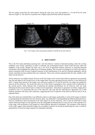 Is Grannum Grading of the Placenta Reproducible.pdf