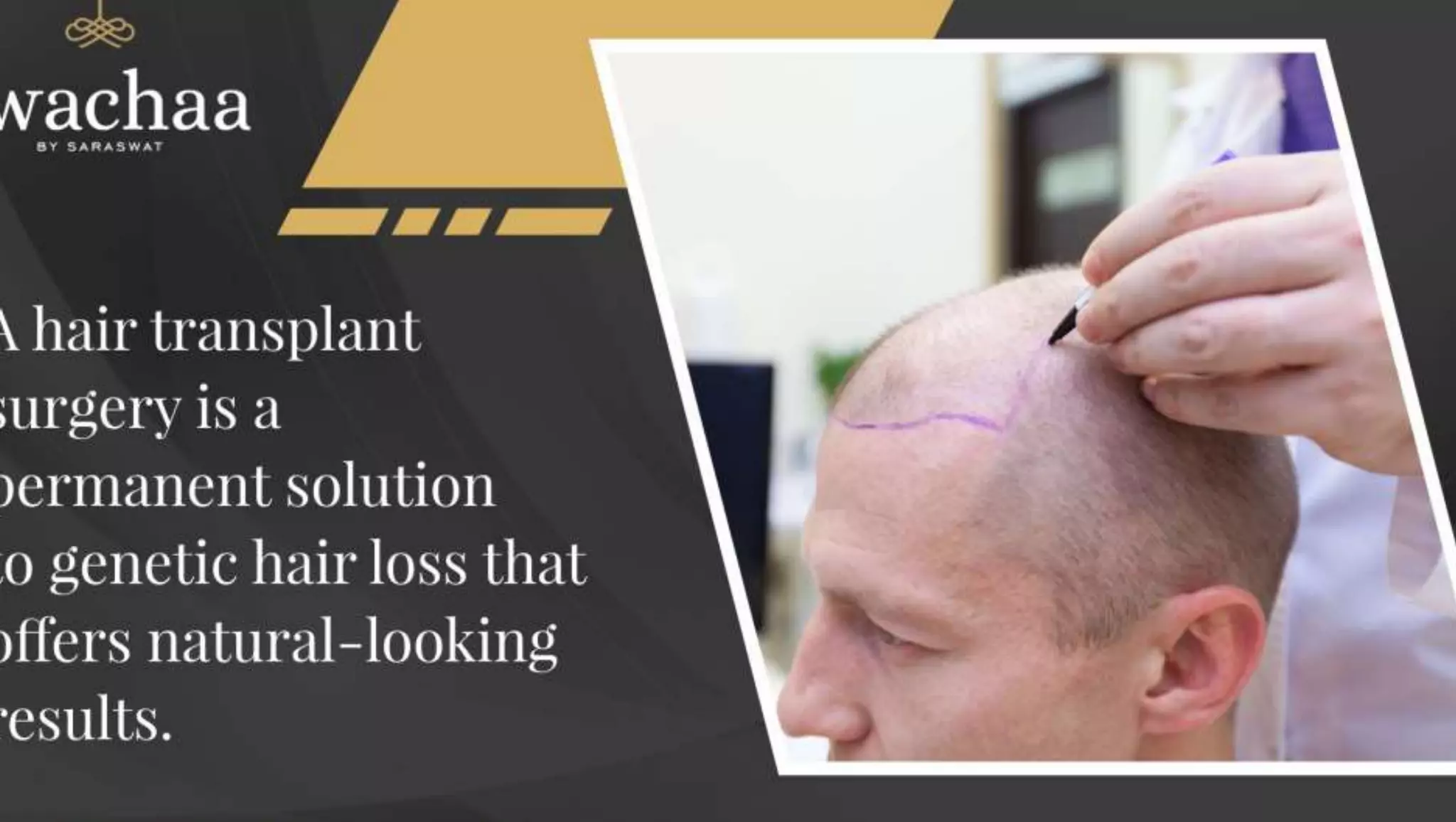 Is hair transplant permanent? | PPTX