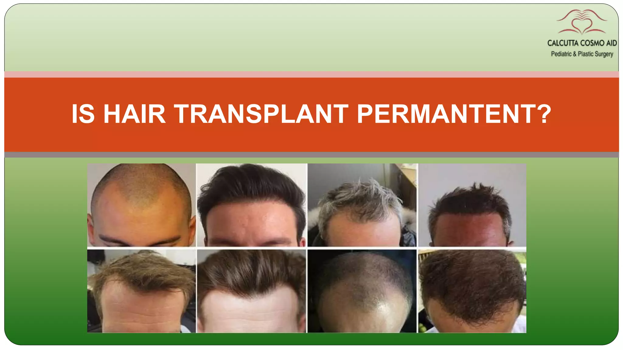 IS HAIR TRANSPLANT PERMANTENT | PPTX